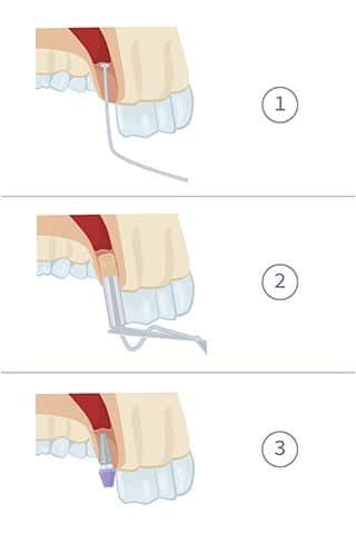 Sinus Surgery - Serene Hills Dentistry